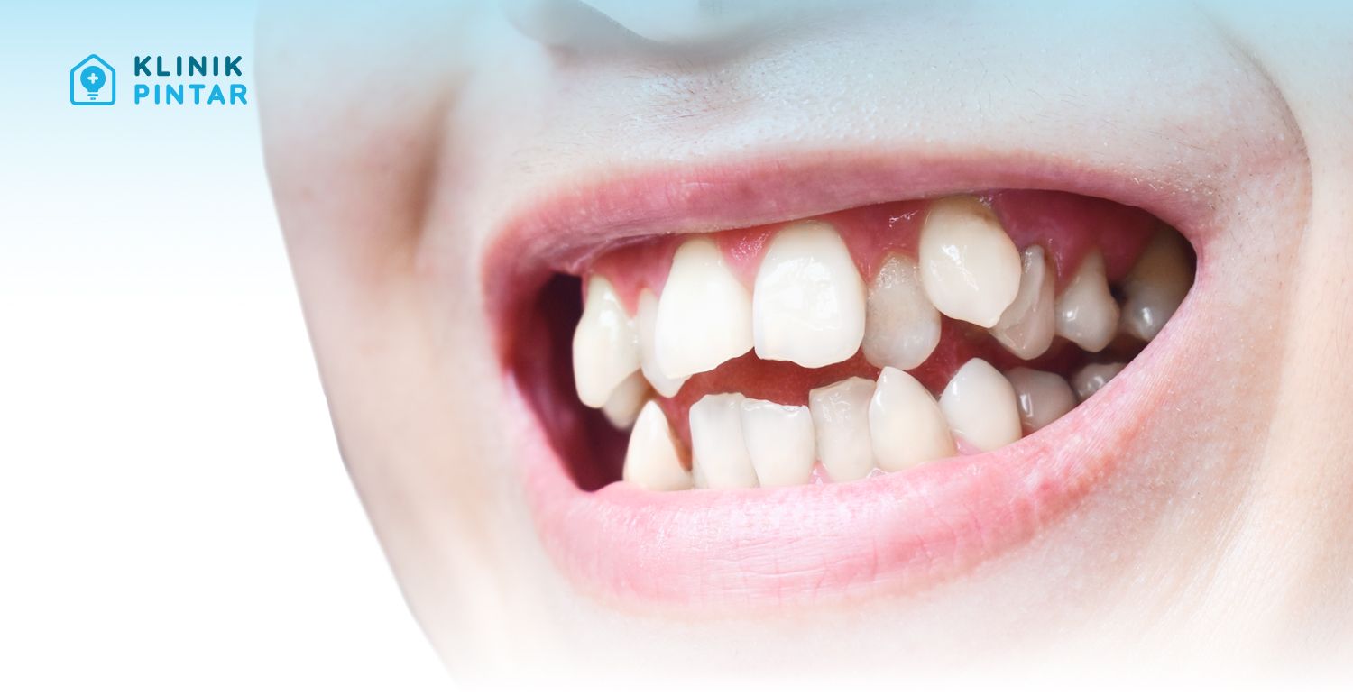 5 Penyebab Gigi Tumbuh Tidak pada Tempatnya dan Cara Mengatasinya